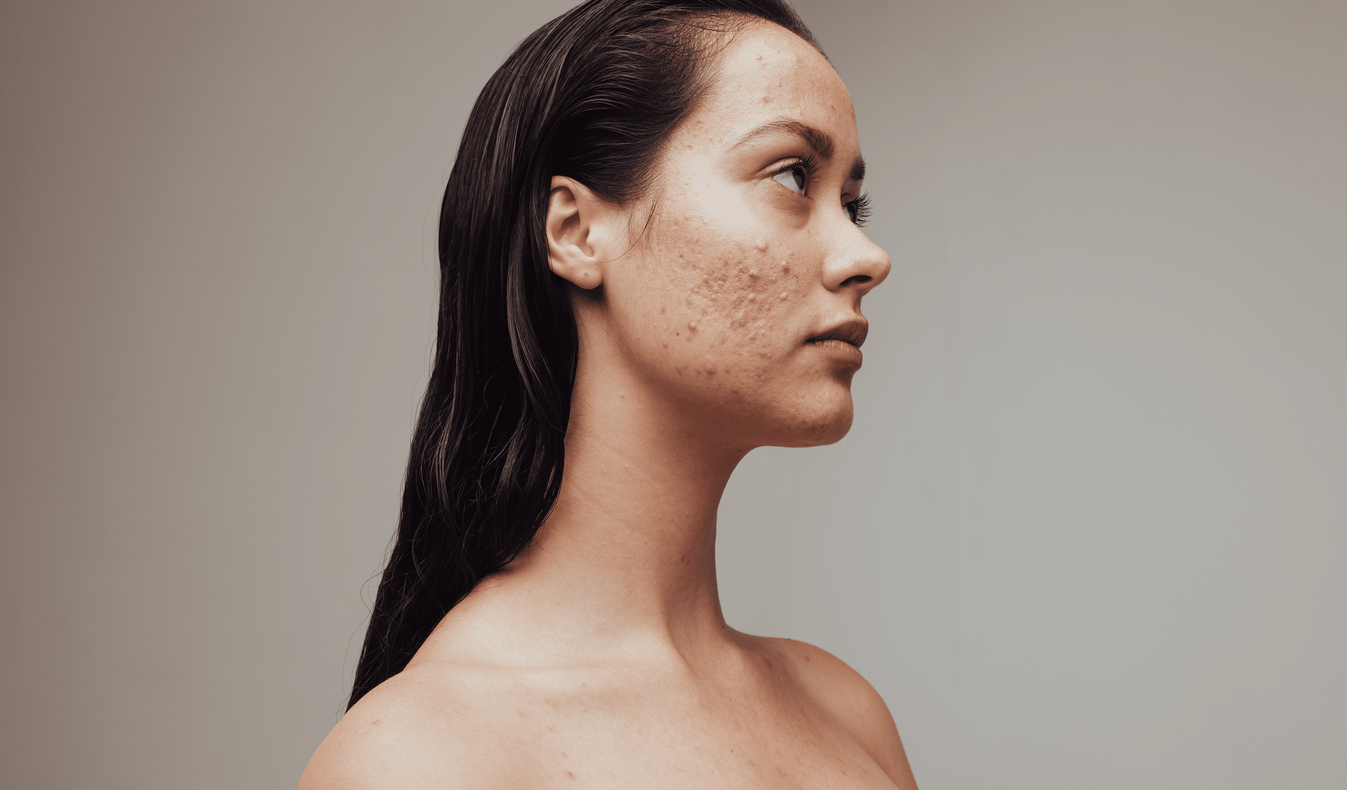 Les imperfections cutanées : ce que vous devez savoir – Les Remèdes de ...